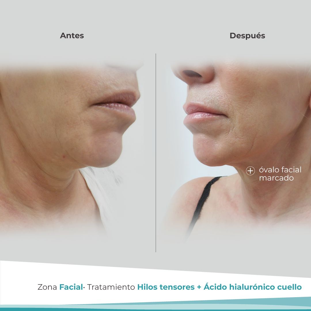 ¿Te preocupa la flacidez en el cuello? Descubre los mejores ...